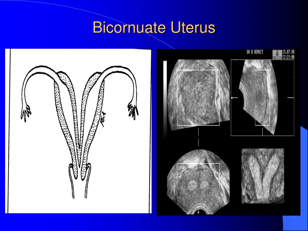 PPT - Mullerian Anomalies By Elizabeth Diaz PowerPoint Presentation ...