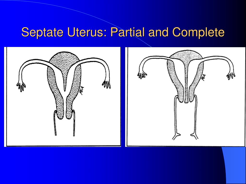 PPT - Mullerian Anomalies By Elizabeth Diaz PowerPoint Presentation ...