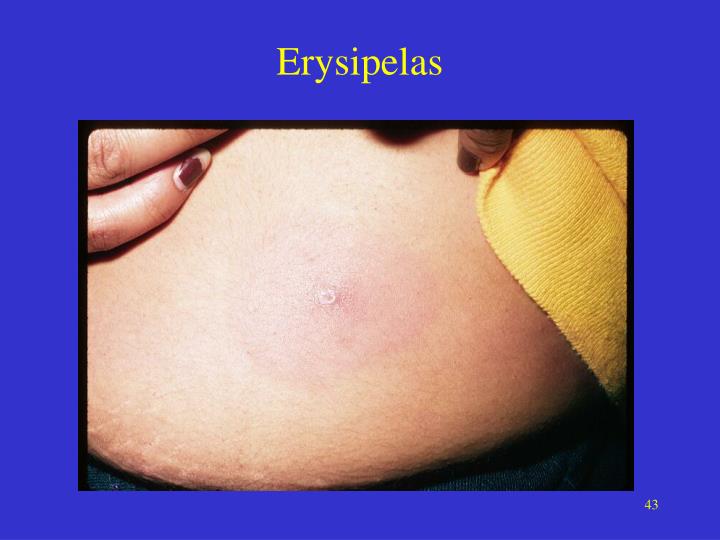 PPT - Bacterial Infections Chapter 14 PowerPoint Presentation - ID:1932