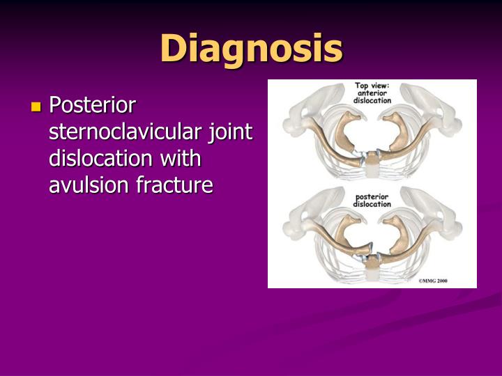 PPT - Sternoclavicular joint dislocation PowerPoint Presentation - ID ...