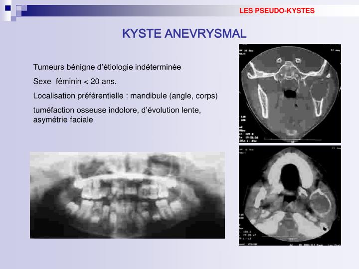 PPT - KYSTES ET TUMEURS MAXILLO-MANDIBULAIRES PowerPoint Presentation ...