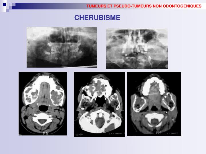 PPT - KYSTES ET TUMEURS MAXILLO-MANDIBULAIRES PowerPoint Presentation ...
