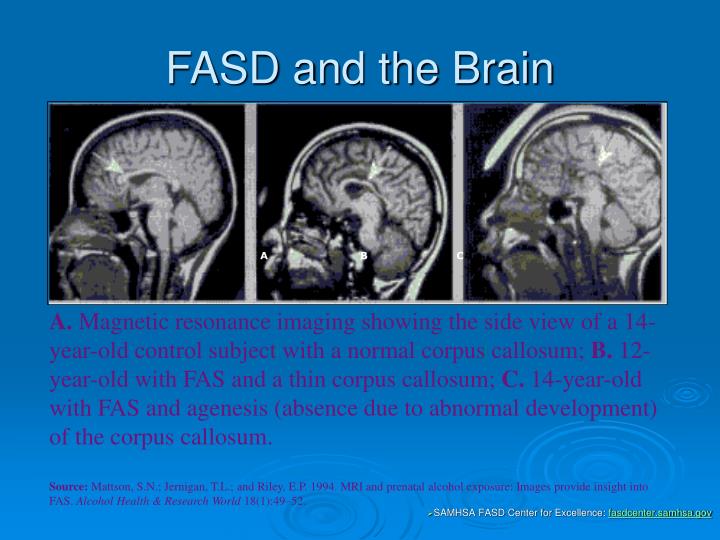 PPT - Fetal Alcohol Spectrum Disorders (FASD) PowerPoint Presentation ...