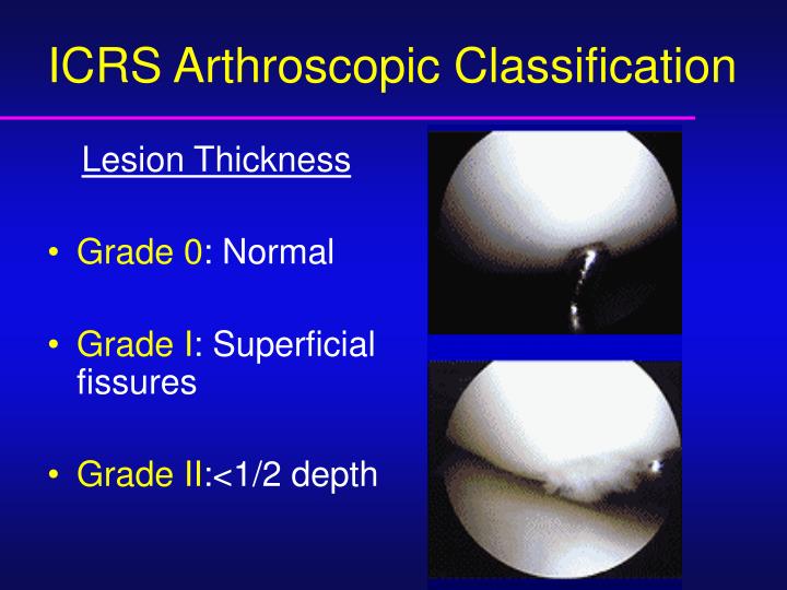PPT - Management of Chondral and Osteochondral defects of Knee joint ...