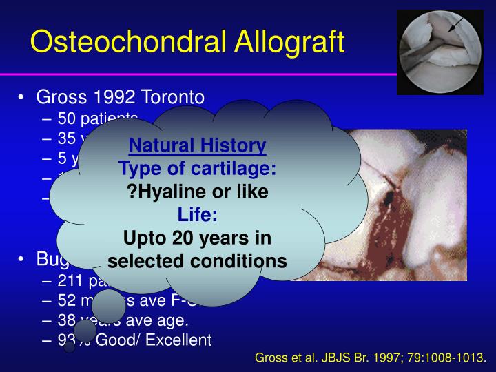 PPT - Management of Chondral and Osteochondral defects of Knee joint ...
