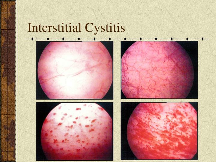 PPT - Endoscopy and Radiology for Lower Urinary Tract Dysfunction ...