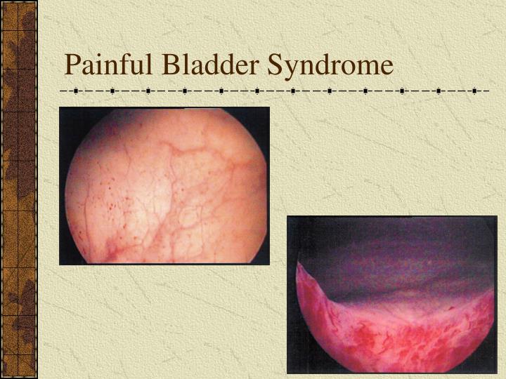 PPT - Endoscopy and Radiology for Lower Urinary Tract Dysfunction ...