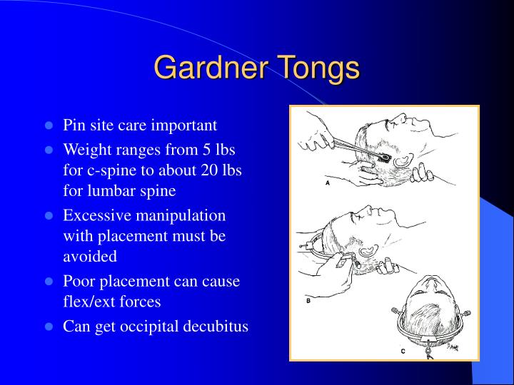 PPT - Orthopaedic Traction PowerPoint Presentation - ID:210938