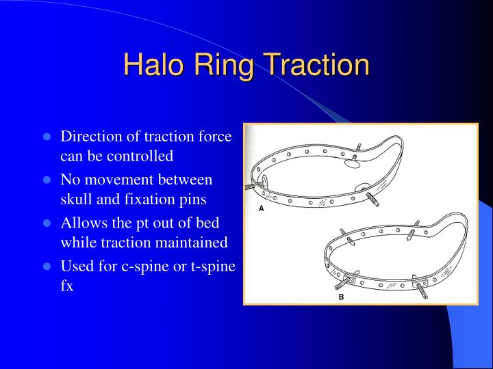 PPT - Orthopaedic Traction PowerPoint Presentation - ID:210938