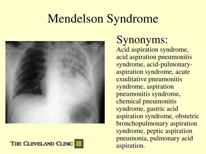 PPT - Making The Case for Cricoid Pressure PowerPoint Presentation - ID ...