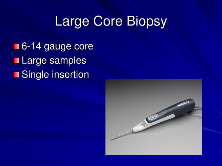 PPT - Benign Breast Disease PowerPoint Presentation - ID:214863