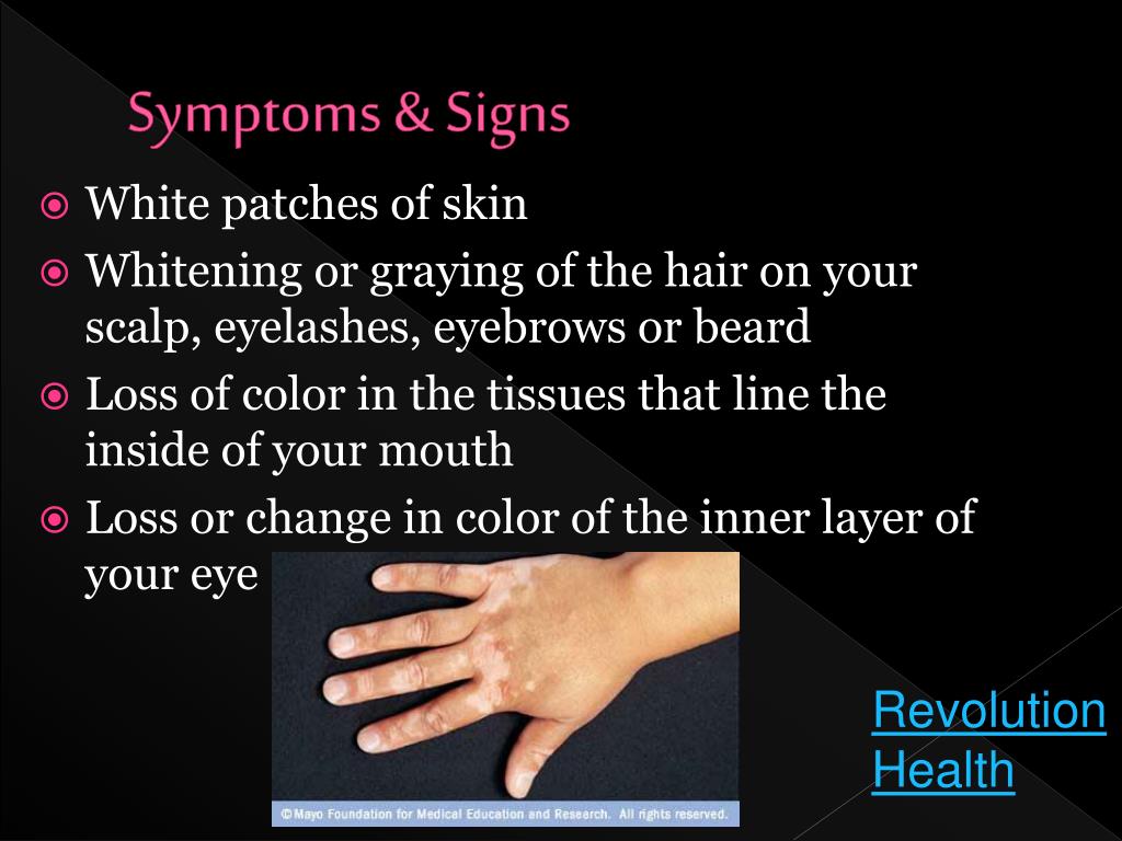 Ppt Vitiligo Powerpoint Presentation Free Download Id217859