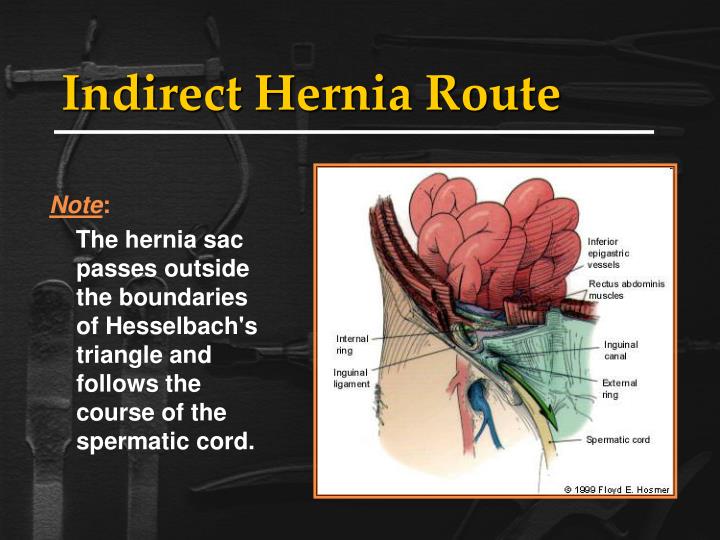 PPT - Inguinal Hernias PowerPoint Presentation - ID:218475