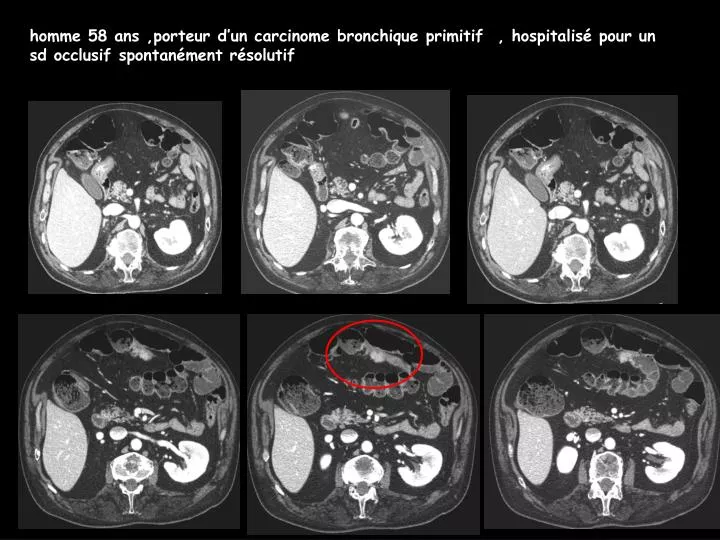 PPT - homme 58 ans ,porteur d’un carcinome bronchique primitif ...
