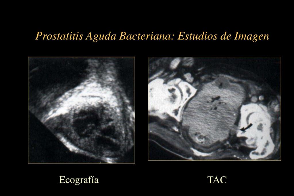PPT - INFECCION URINARIA PowerPoint Presentation, free download - ID:223979