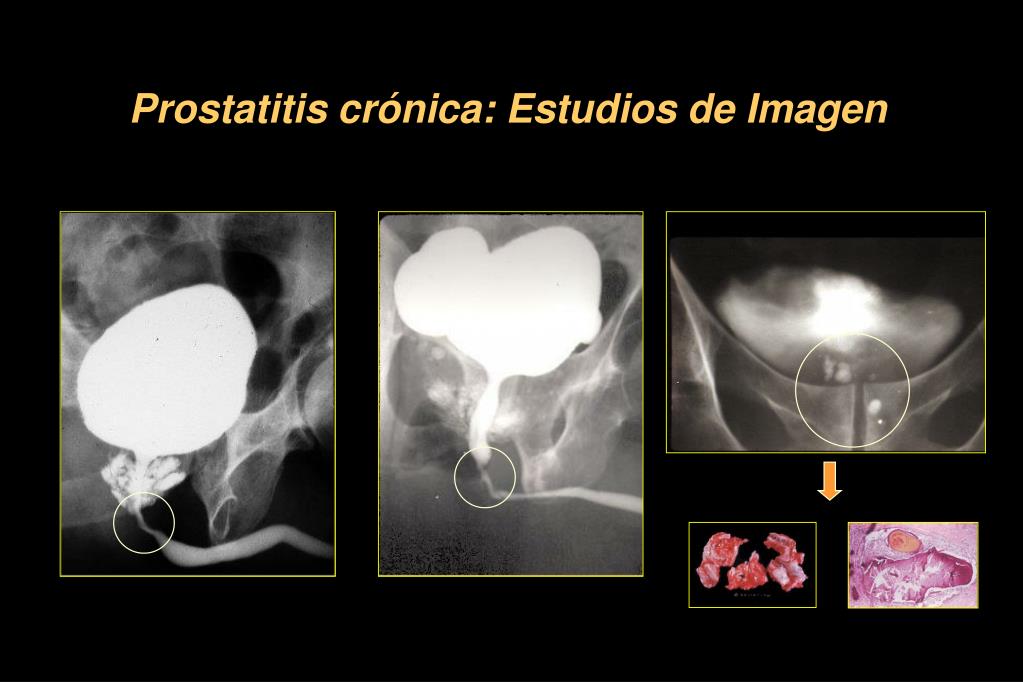 PPT - INFECCION URINARIA PowerPoint Presentation, free download - ID:223979