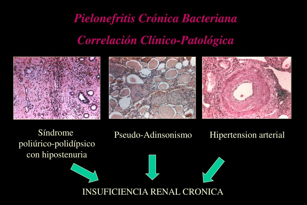 PPT - INFECCION URINARIA PowerPoint Presentation, free download - ID:223979