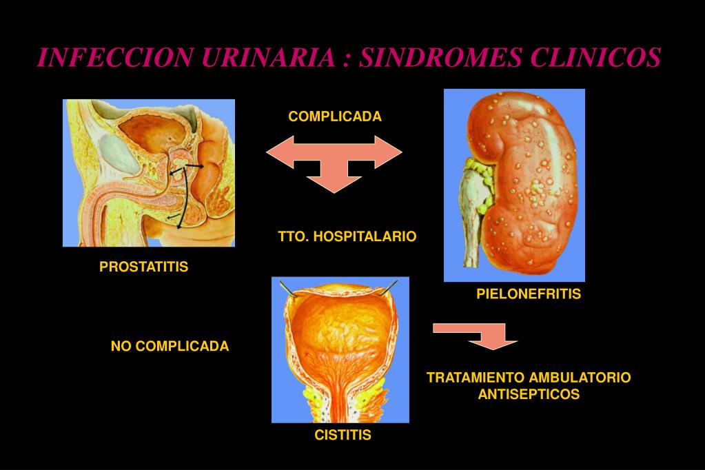 PPT - INFECCION URINARIA PowerPoint Presentation, free download - ID:223979