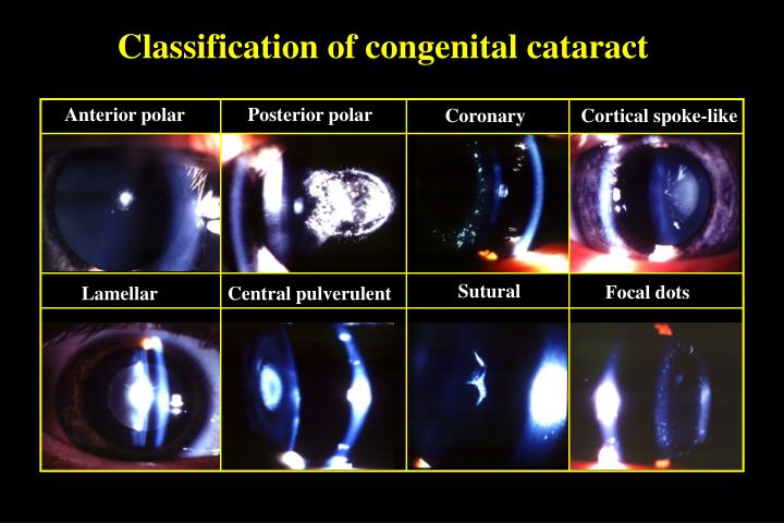 PPT - CONGENITAL CATARACT PowerPoint Presentation - ID:225627