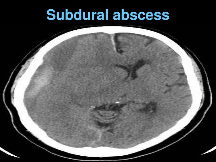 PPT - Complications of Suppurative Otitis Media PowerPoint Presentation ...