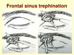 PPT - Surgical Treatment of Sinusitis PowerPoint Presentation - ID:226352