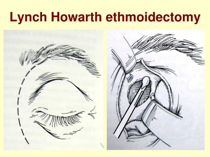 PPT - Surgical Treatment of Sinusitis PowerPoint Presentation - ID:226352