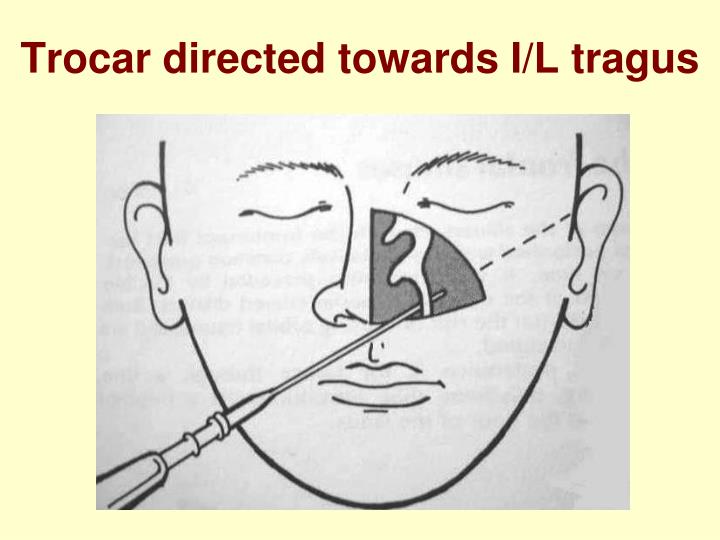 PPT - Surgical Treatment of Sinusitis PowerPoint Presentation - ID:226352
