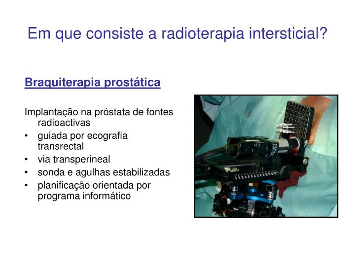 PPT - Patologia Prostática Hipertrofia Prostática Carcinoma da Próstata ...
