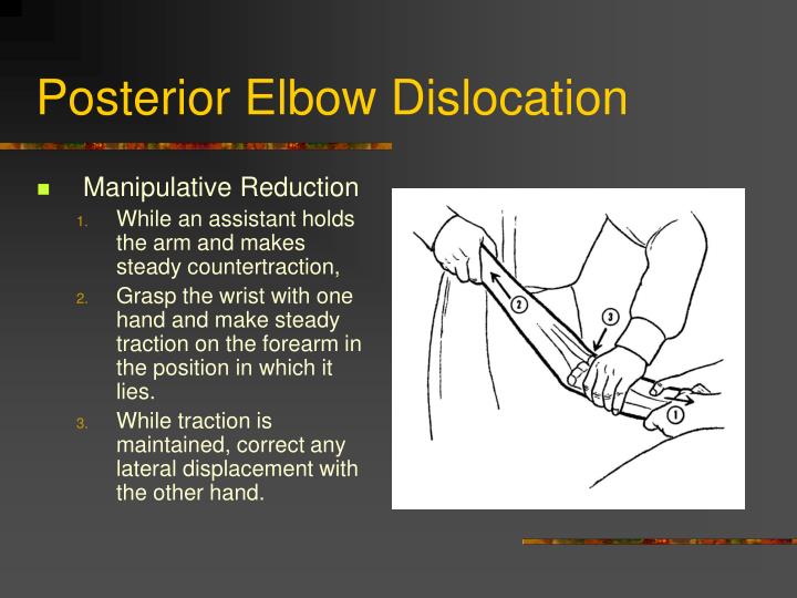 PPT - Dislocation and Fracture Reductions PowerPoint Presentation - ID ...