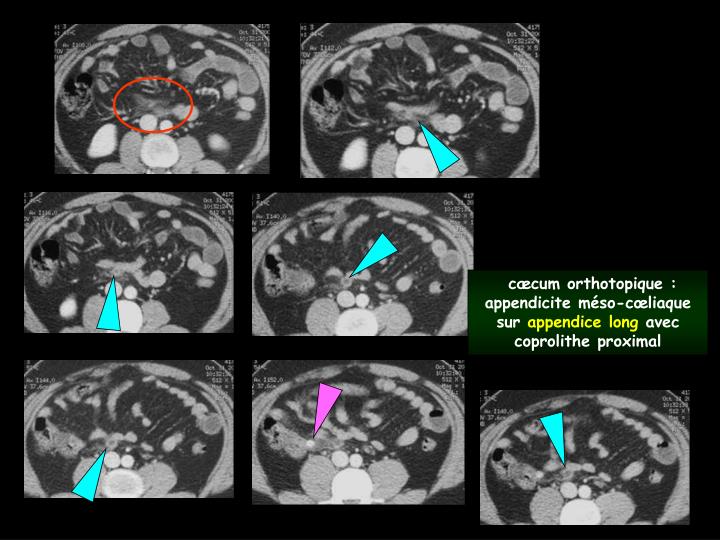 PPT - pourquoi le scanner dans l'appendicite aiguë et ses complications ...