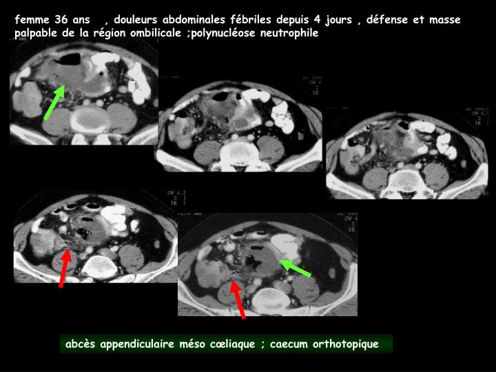PPT - pourquoi le scanner dans l'appendicite aiguë et ses complications ...