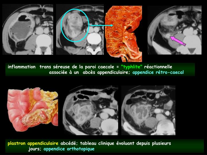PPT - pourquoi le scanner dans l'appendicite aiguë et ses complications ...