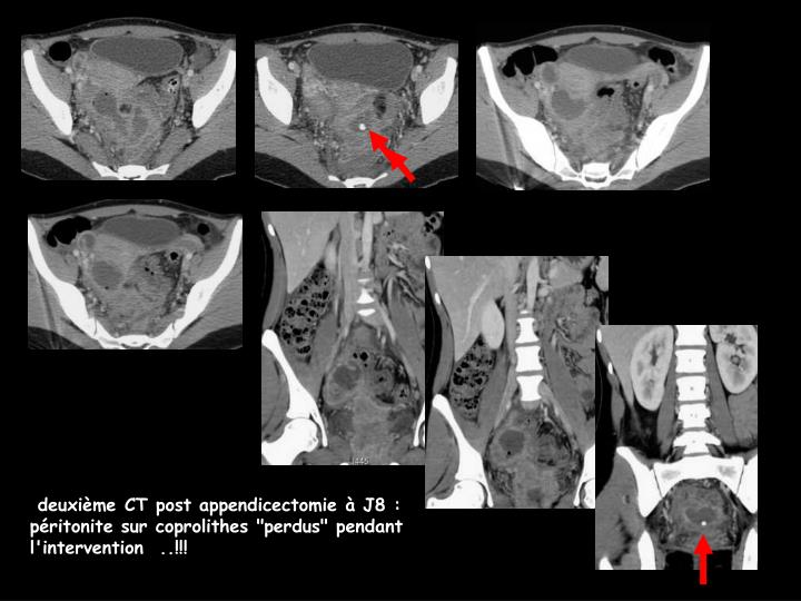 PPT - pourquoi le scanner dans l'appendicite aiguë et ses complications ...