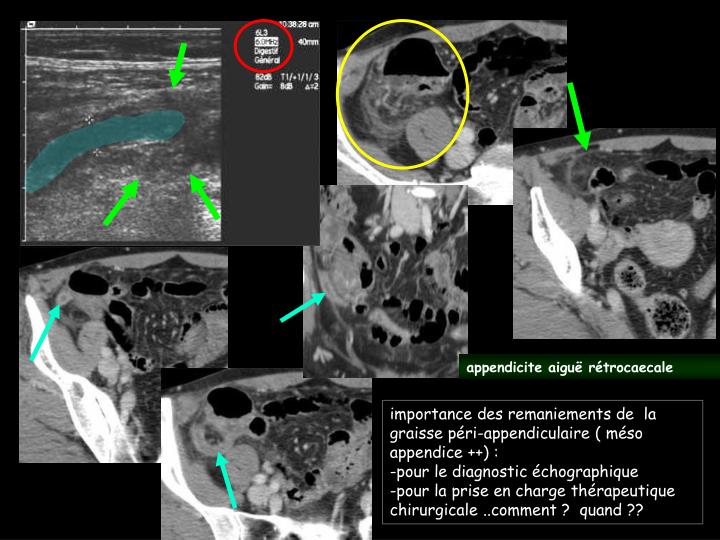 PPT - pourquoi le scanner dans l'appendicite aiguë et ses complications ...
