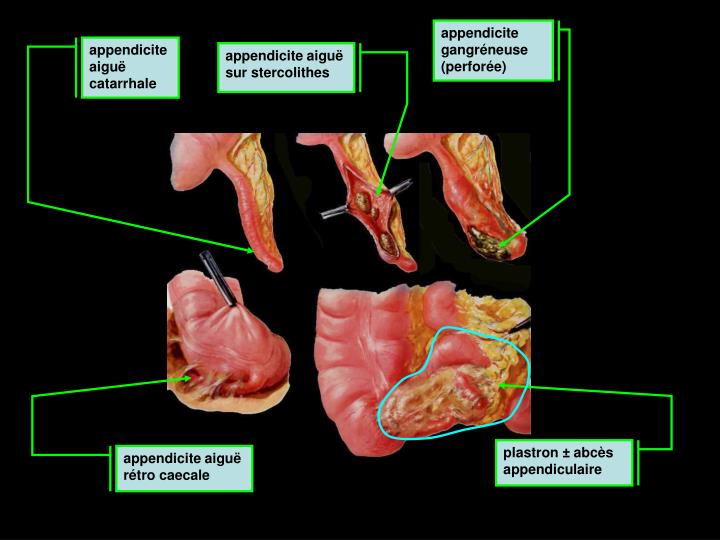 PPT - pourquoi le scanner dans l'appendicite aiguë et ses complications ...