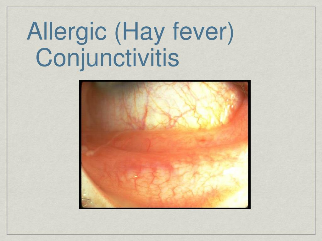 PPT - Essentials of Ophthalmology PowerPoint Presentation - ID:22855