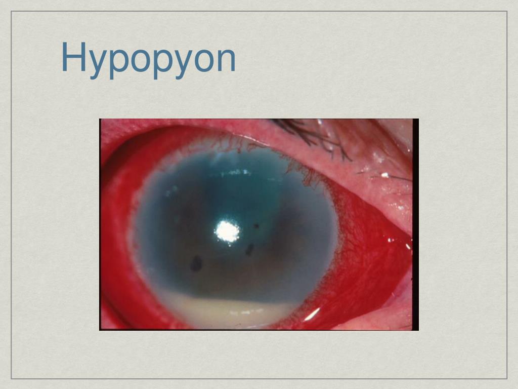 PPT - Essentials of Ophthalmology PowerPoint Presentation - ID:22855