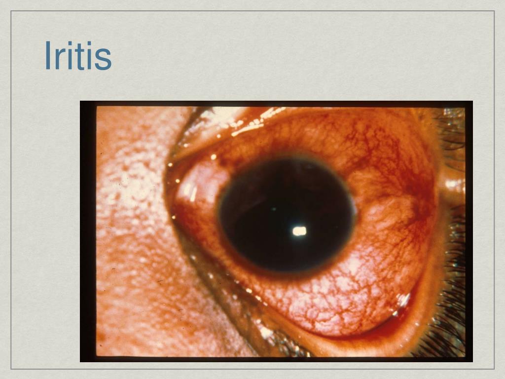 PPT - Essentials of Ophthalmology PowerPoint Presentation - ID:22855