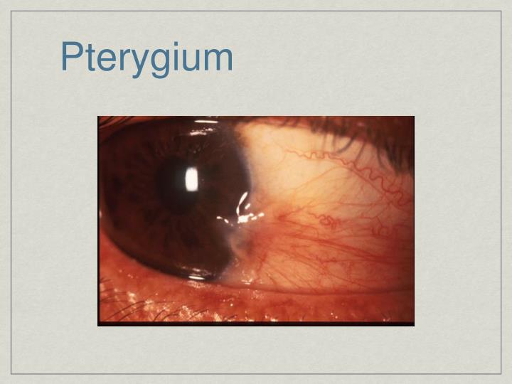 PPT - Essentials of Ophthalmology PowerPoint Presentation - ID:22855