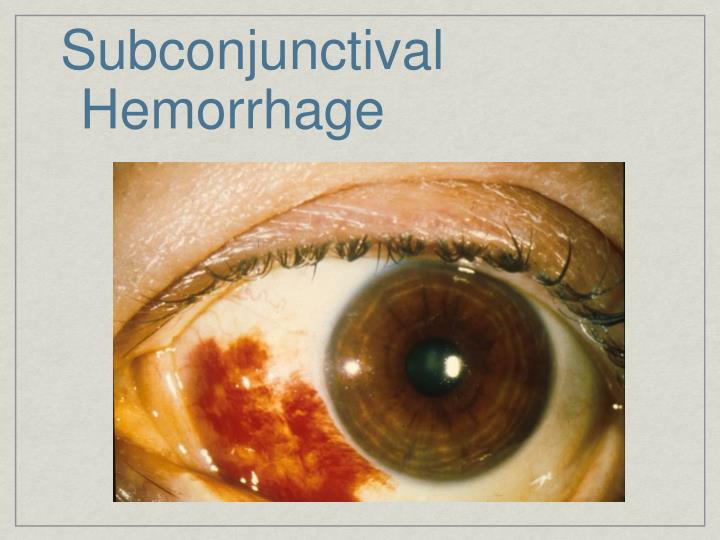 PPT - Essentials of Ophthalmology PowerPoint Presentation - ID:22855