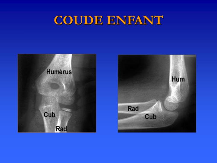 PPT - ANATOMIE RADIOLOGIQUE DU COUDE PowerPoint Presentation - ID:231059