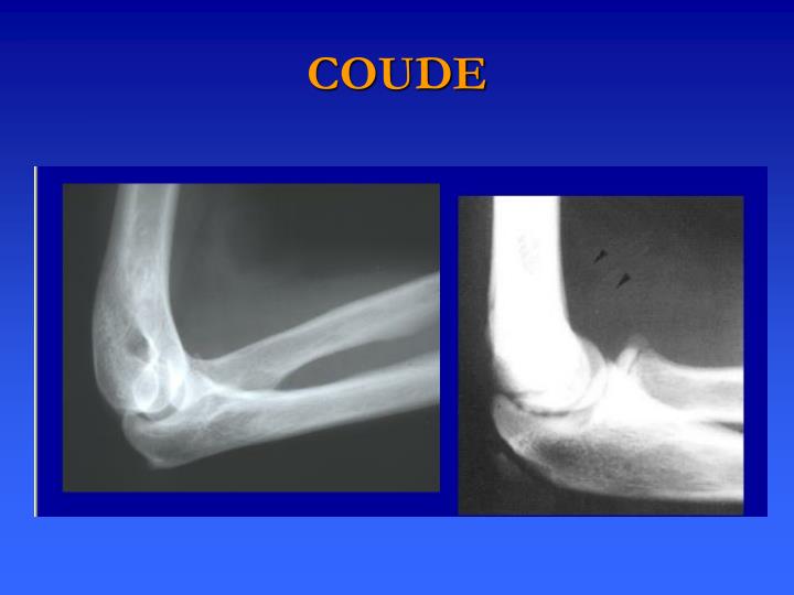 PPT - ANATOMIE RADIOLOGIQUE DU COUDE PowerPoint Presentation - ID:231059