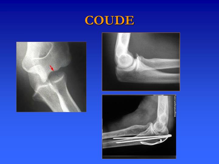 PPT - ANATOMIE RADIOLOGIQUE DU COUDE PowerPoint Presentation - ID:231059