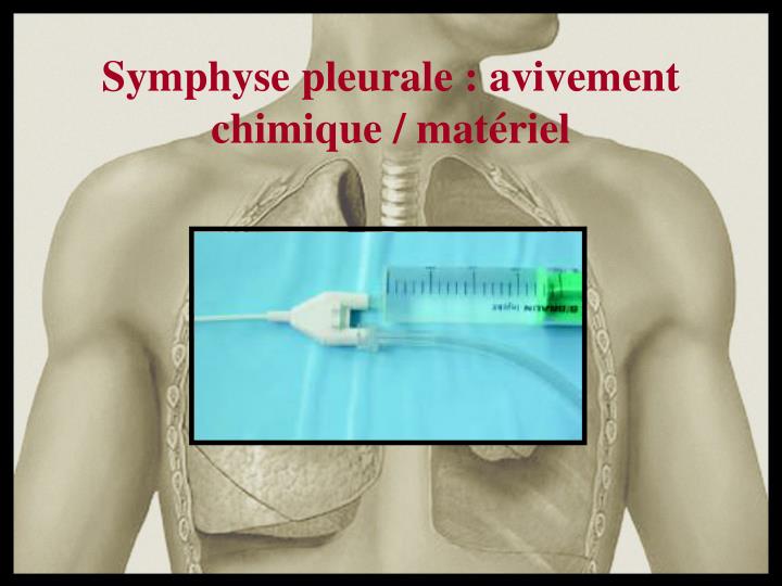 PPT - Traitement chirurgical du pneumothorax spontané PowerPoint ...