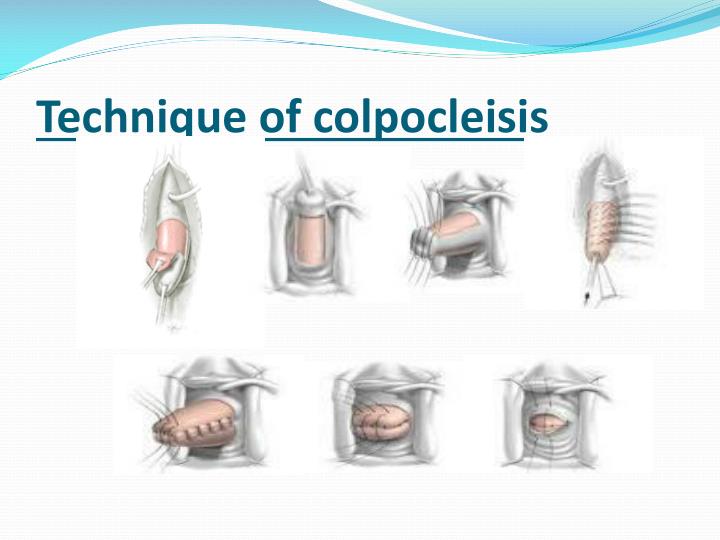 PPT - Outcome of Colpocleisis : A Ten year case series PowerPoint ...