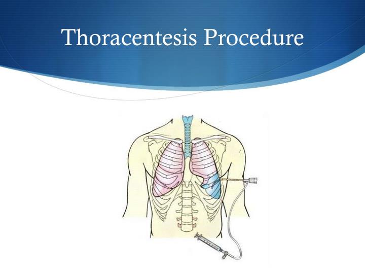 PPT - Spontaneous Pneumothorax In the Newborn PowerPoint Presentation ...