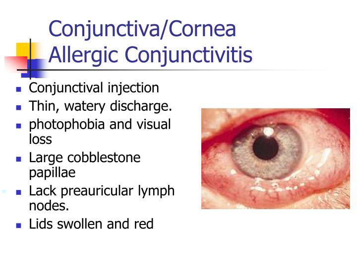 PPT - The Differential Diagnosis of The Red Eye PowerPoint Presentation ...
