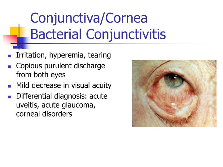 PPT - The Differential Diagnosis of The Red Eye PowerPoint Presentation ...