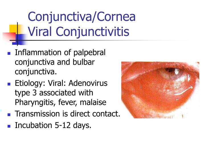 PPT - The Differential Diagnosis of The Red Eye PowerPoint Presentation ...