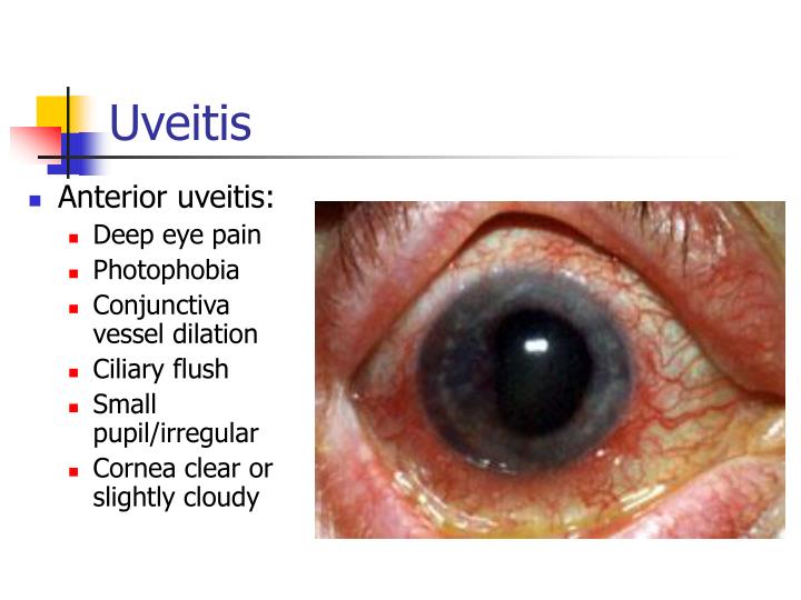 PPT - The Differential Diagnosis of The Red Eye PowerPoint Presentation ...